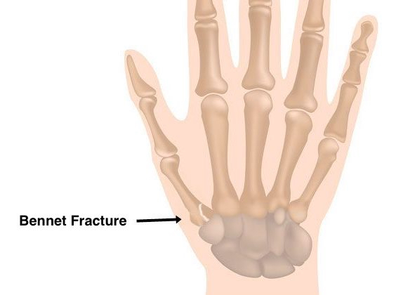What is a Bennett fracture dislocation? - Azouz Hand SurgeryAzouz Hand ...