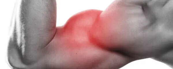 Bicep tendon rupture surgery | Dallas Hand Surgeon Dr. AzouzAzouz Hand ...