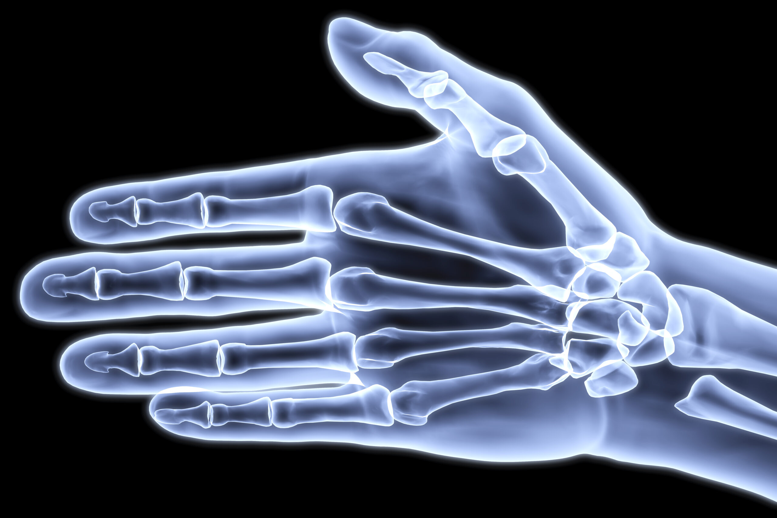 Hand Fractures | Dallas Hand Surgeon Dr. AzouzAzouz Hand Surgery